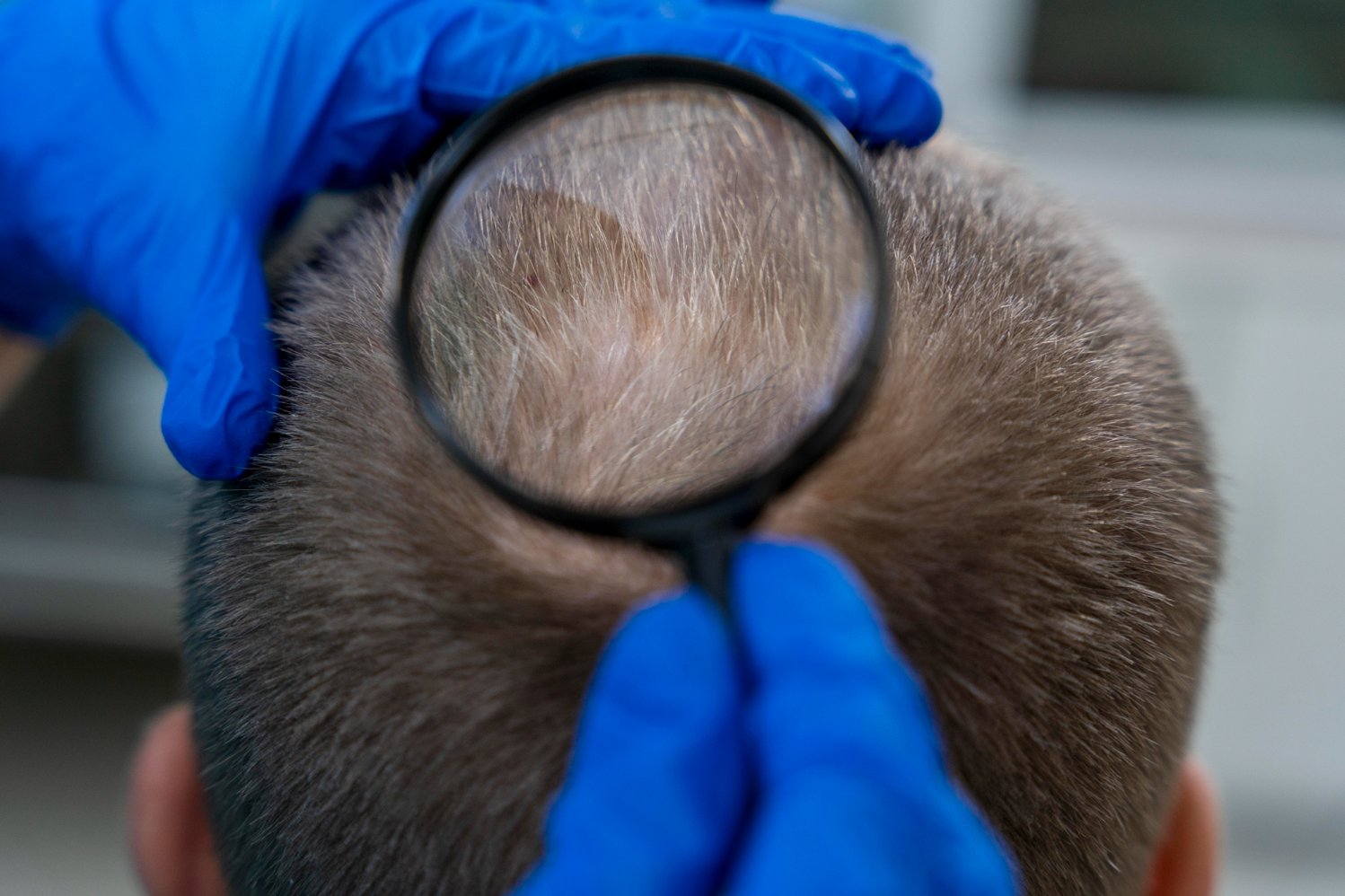Alopecia Areata Explained: A Comprehensive Guide to Hair Loss