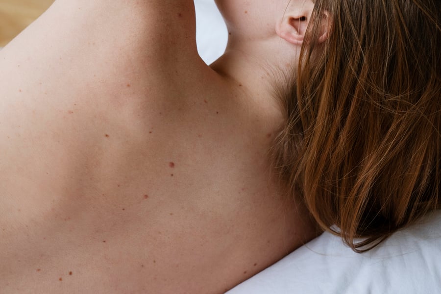 What is Back Acne (Bacne)? Causes & Solutions