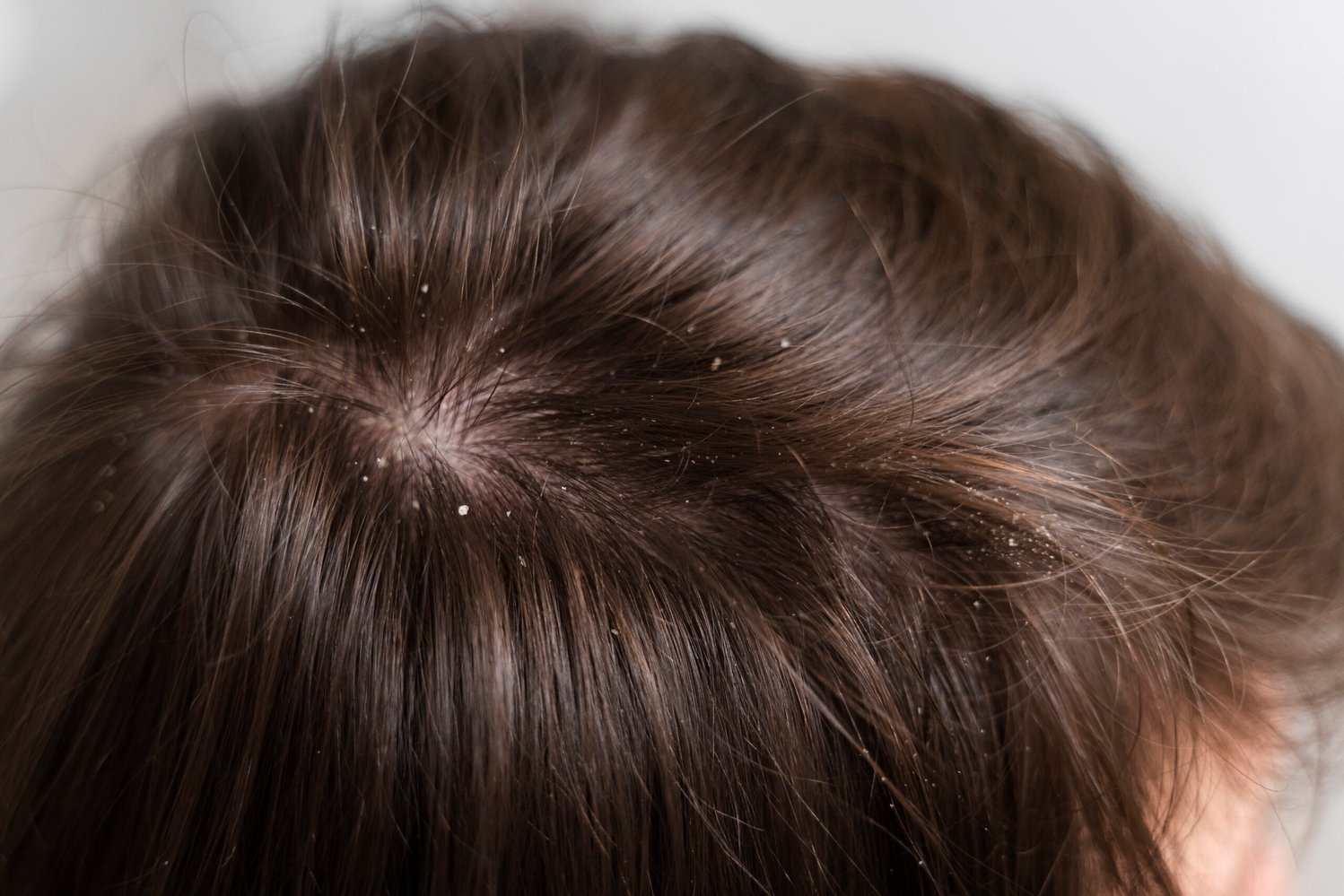 Step-by-Step Guide: Get rid of dandruff : causes, signs and treat