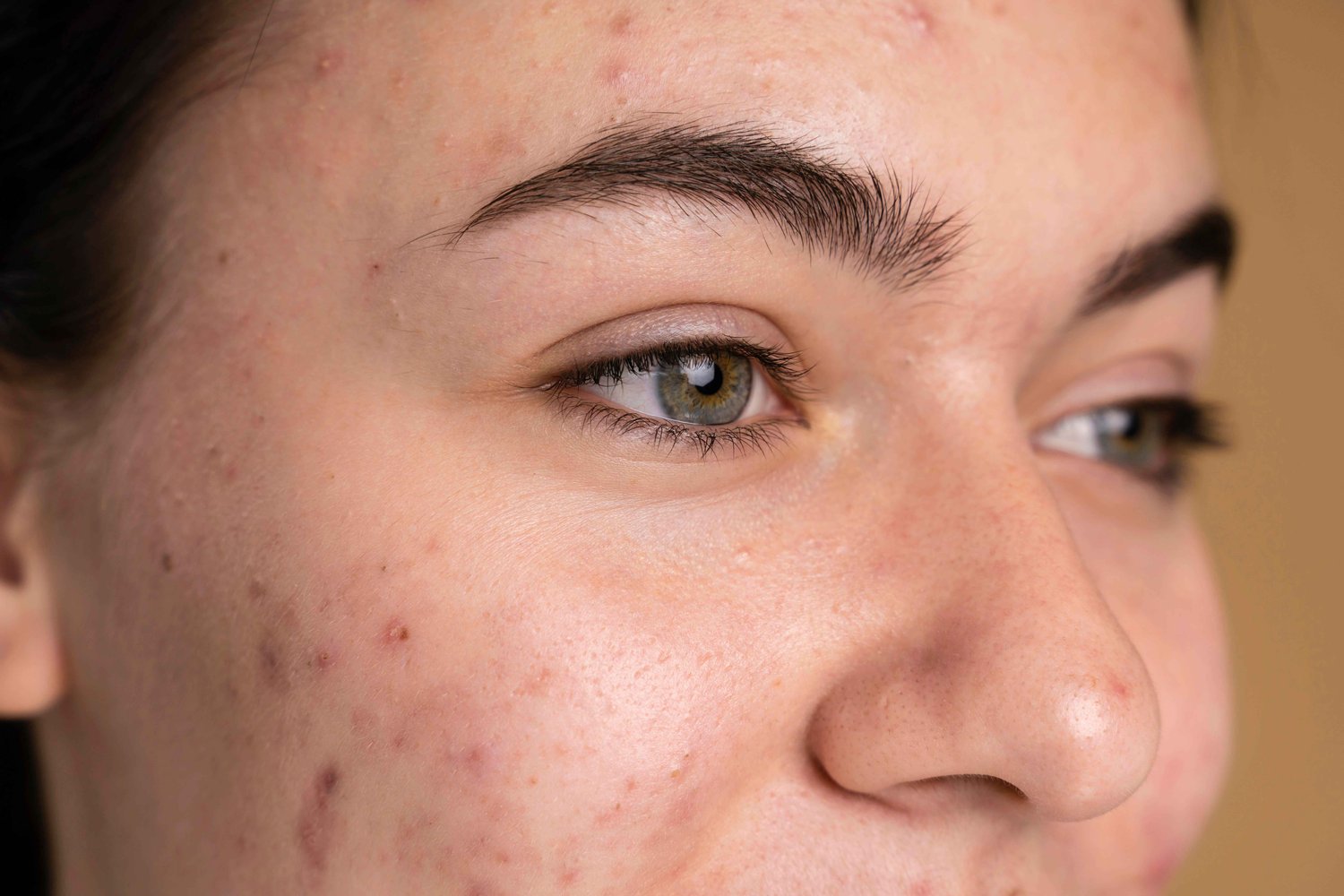 What’s the Difference Between Acne and Pimples?