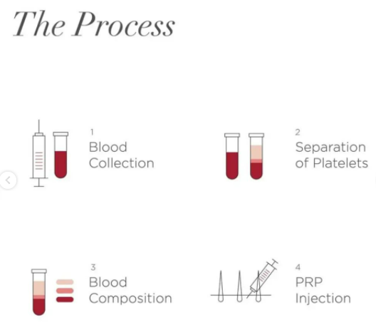 PRP Hair Treatments: Benefits, Results & More